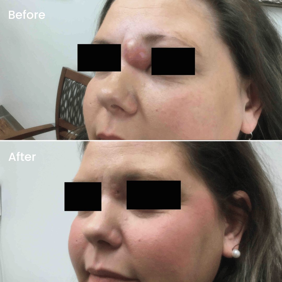 ICLS Cyst Removal Treatment